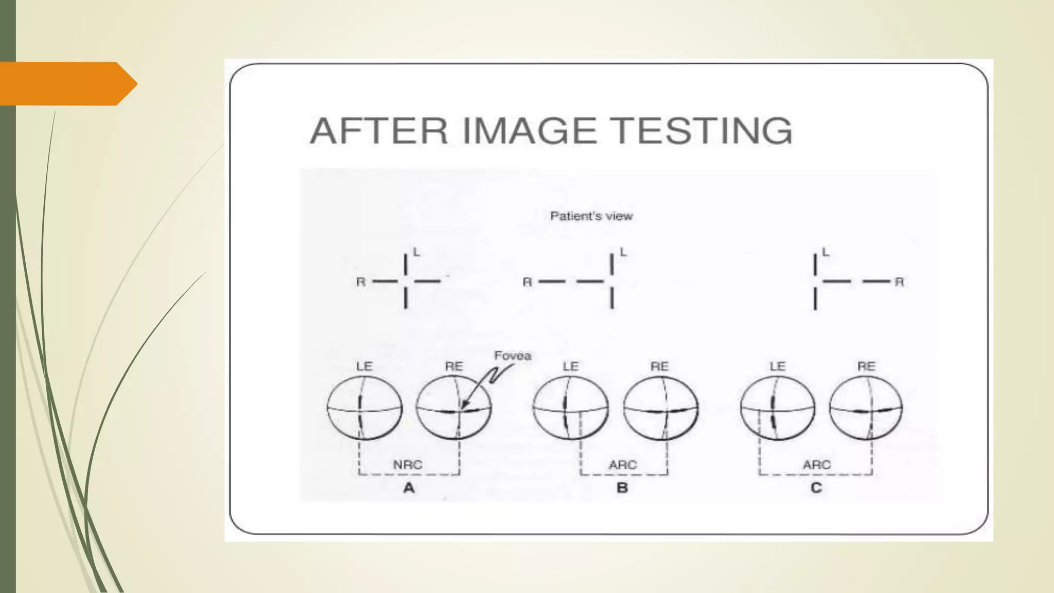 MECHANISMS AND TERMINOLOGIES IN BINOCULAR VISION.pptx | Eye and Vision ...