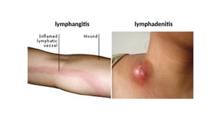Mechanisms of Inflammation.kmu lecture... | PPTX