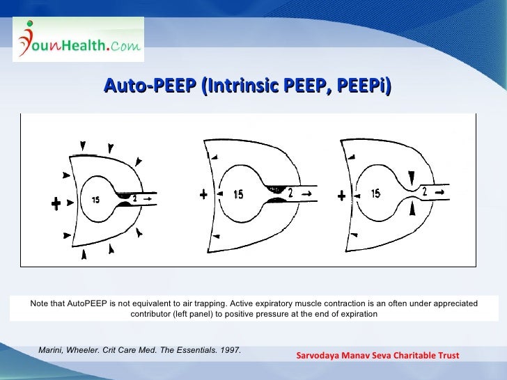 Mechenical ventilation