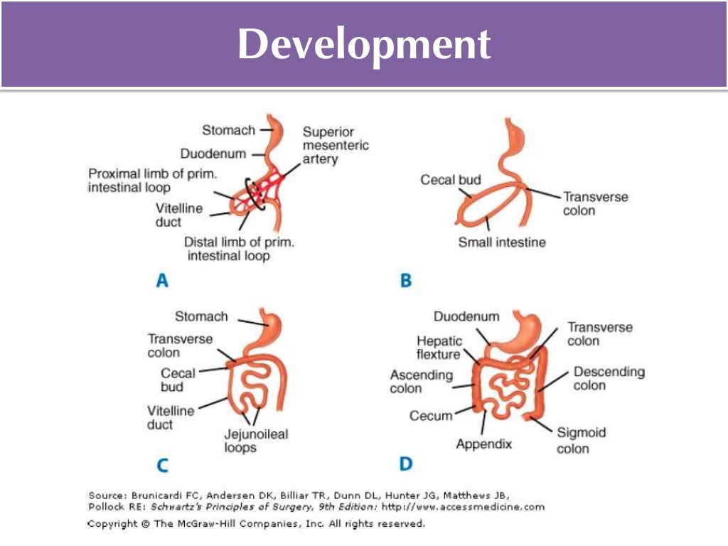 Meckel's diverticulum