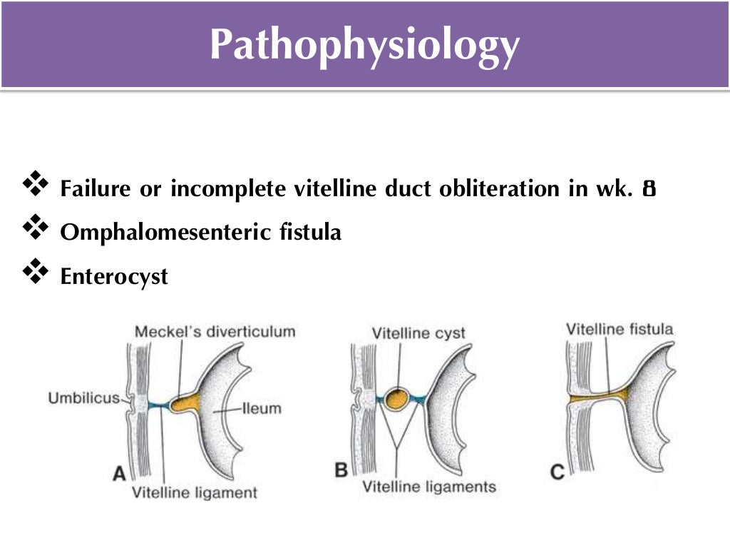 Meckel's diverticulum