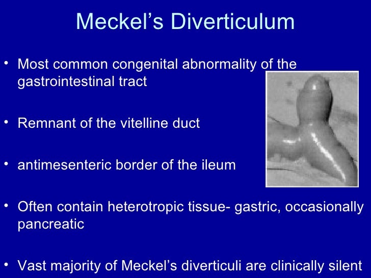 Meckels div