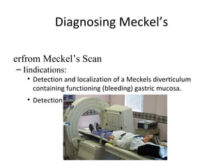 Meckelsdiverticulum | PPT