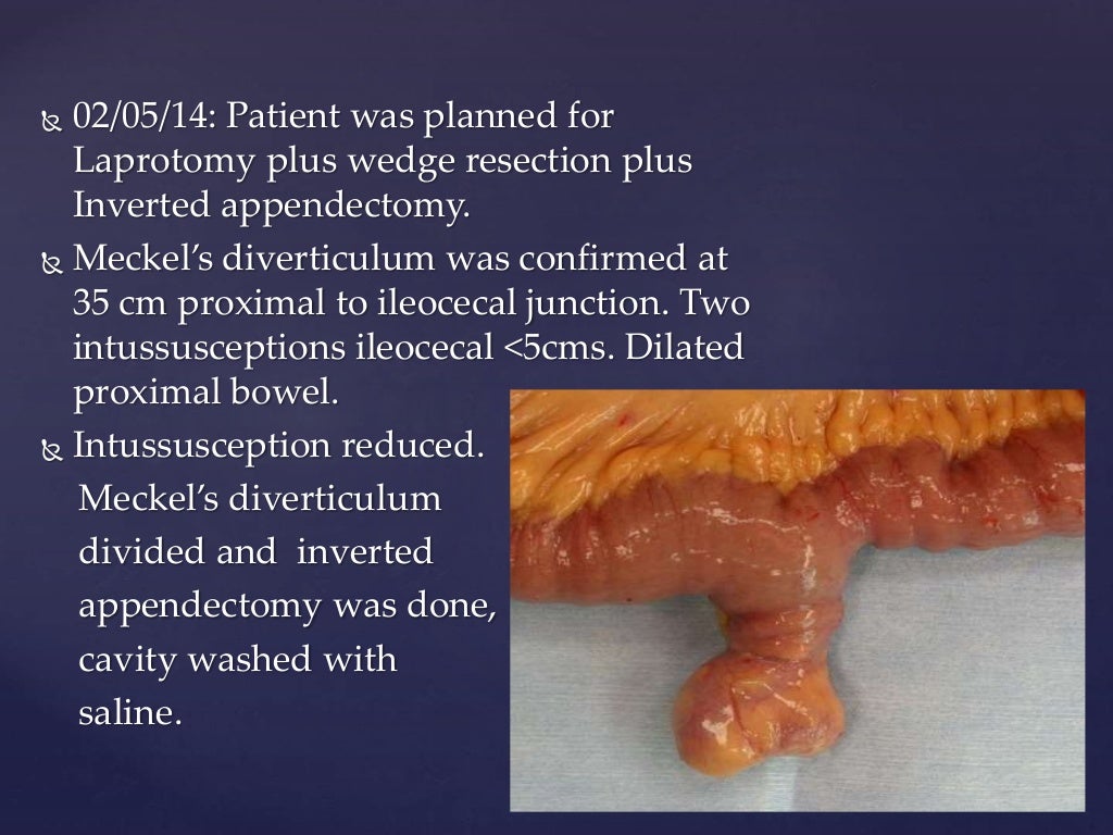 Meckels Diverticulum