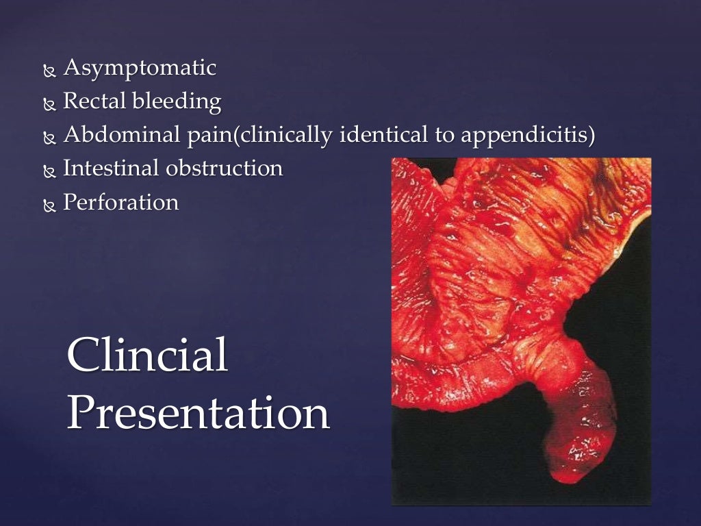 Meckels Diverticulum