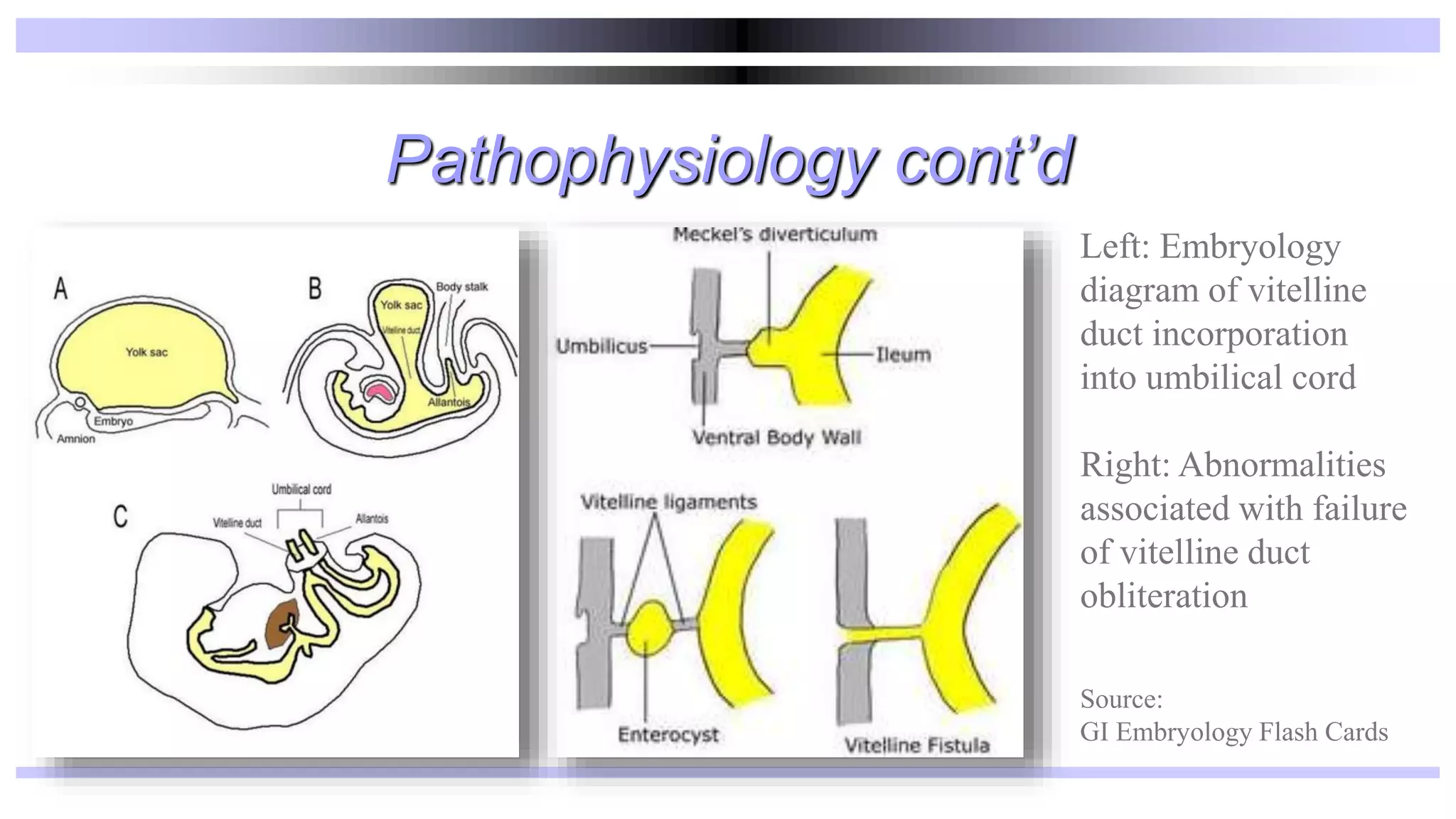 Meckel’s diverticulum | PPTX