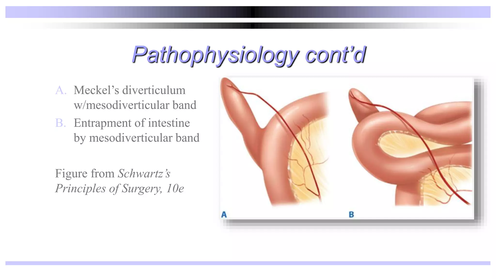 Meckel’s diverticulum | PPTX