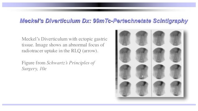 Meckel’s diverticulum