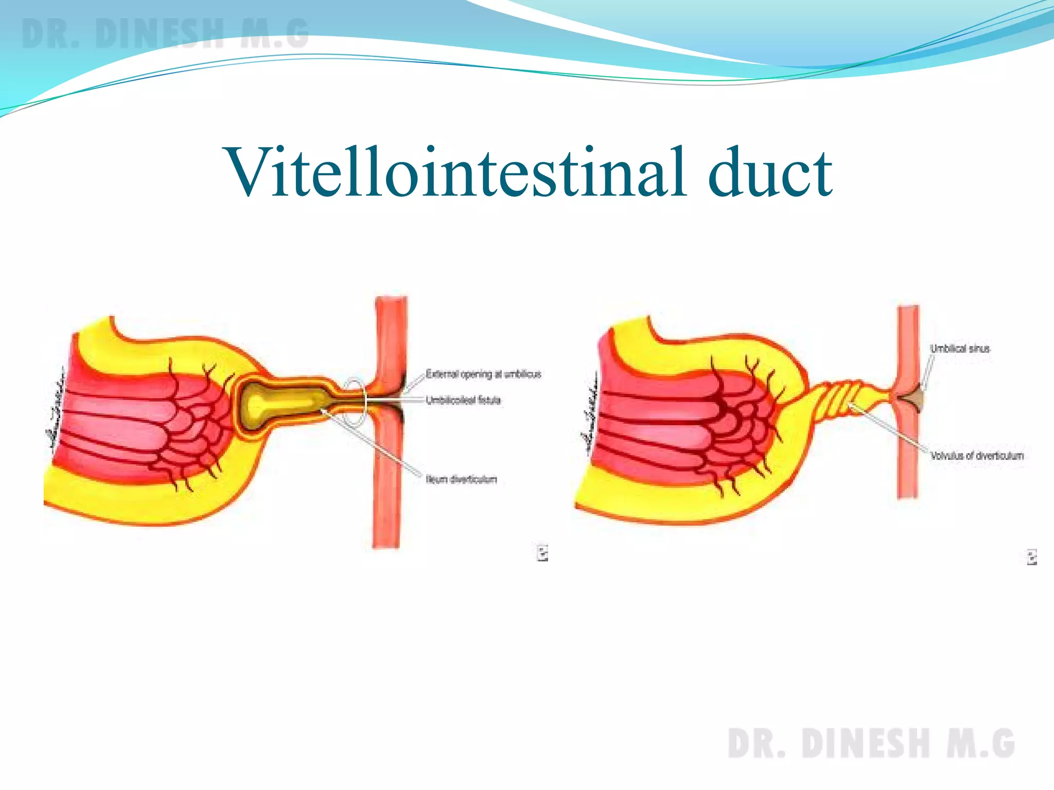 Meckel's Diverticulum | PDF