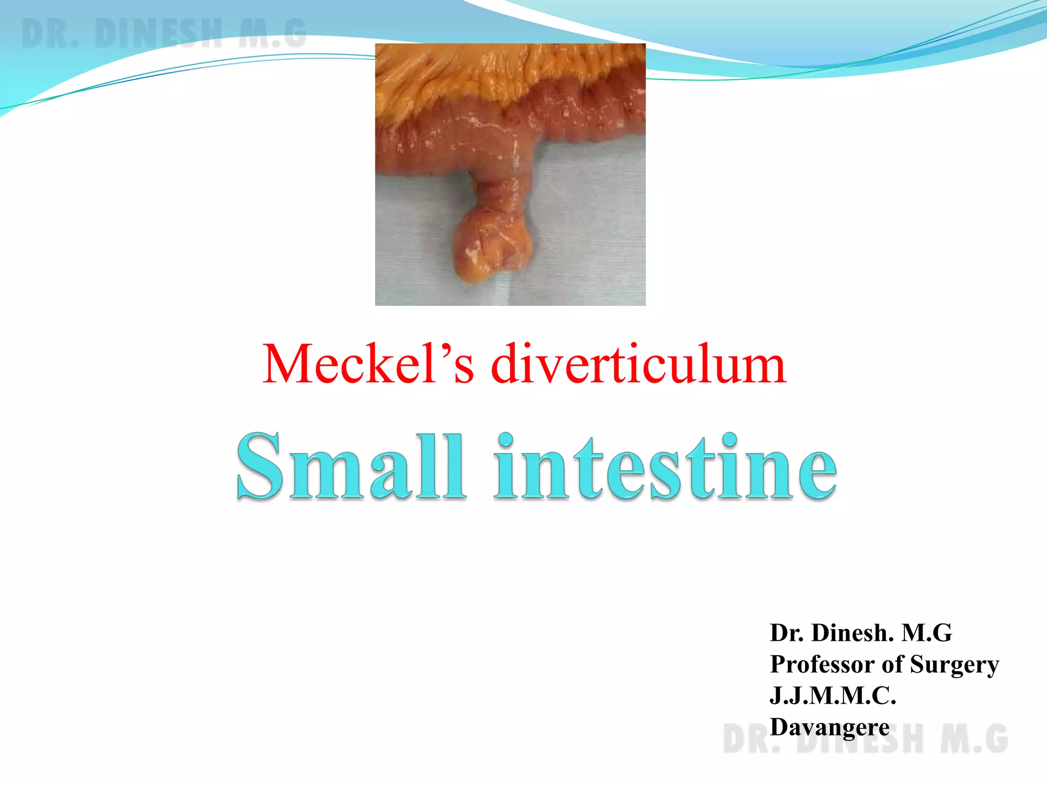 Meckel's Diverticulum | PPT