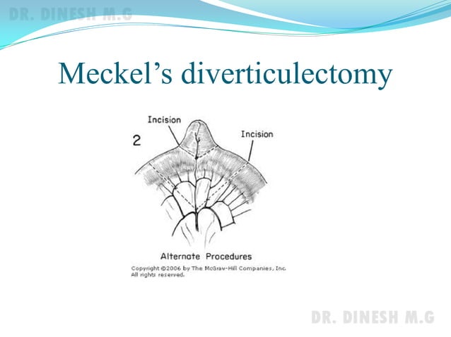 Meckel's Diverticulum
