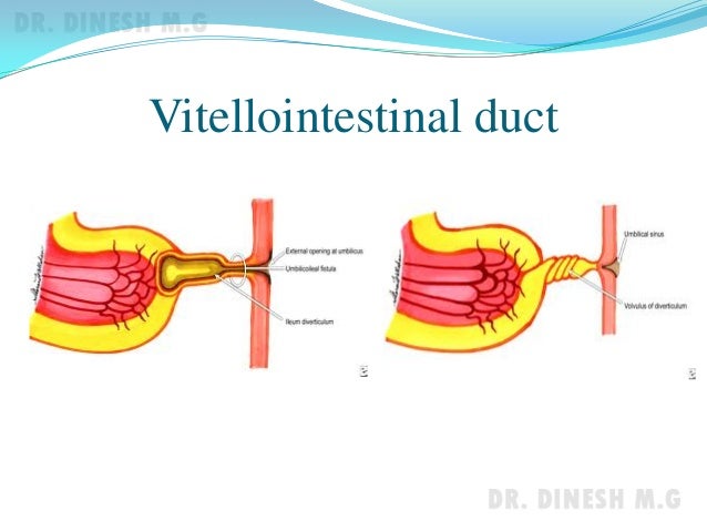 Meckel's Diverticulum
