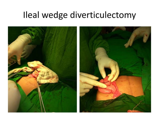 Meckels diverticulum | PPT