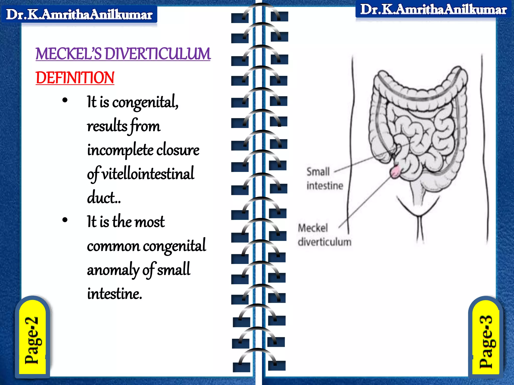 Meckel’s diverticulum by Dr.AmrithaAnilkumar | PPTX