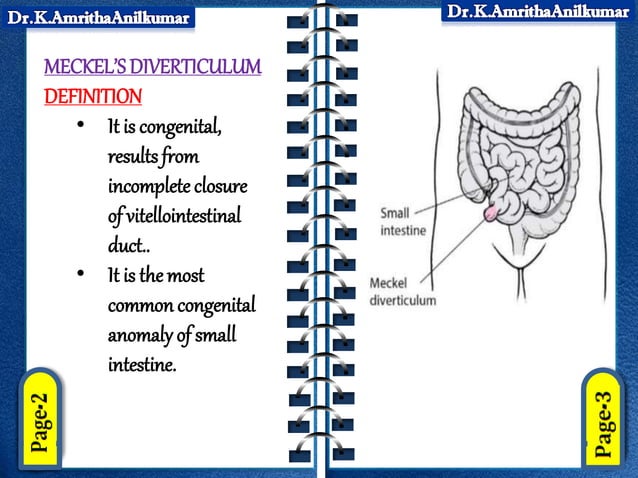 Meckel’s diverticulum by Dr.AmrithaAnilkumar | PPTX | Digestive ...