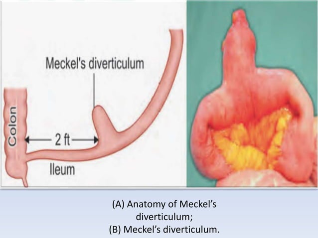 MECKEL’S DIVERTICULUM.pptx
