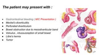 Meckel’s diverticulum.pdf