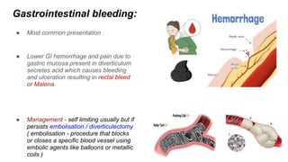 Meckel’s diverticulum.pdf