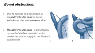 Meckel’s diverticulum.pdf