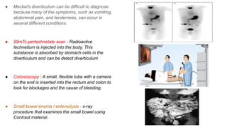 Meckel’s diverticulum.pdf