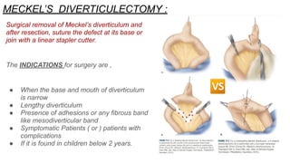 Meckel’s diverticulum.pdf