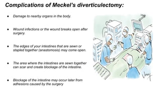 Meckel’s diverticulum.pdf