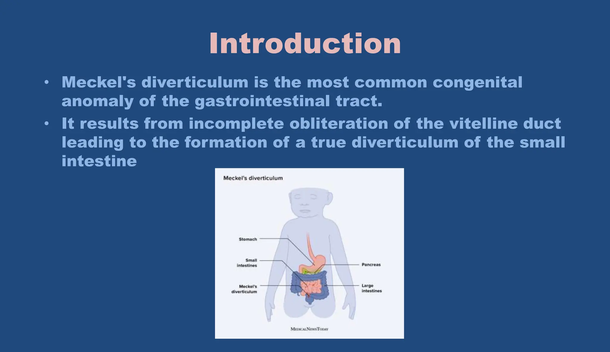 meckels diverticulum.pptx