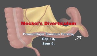 meckels diverticulum.pptx