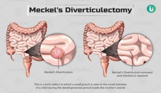 meckels diverticulum.pptx