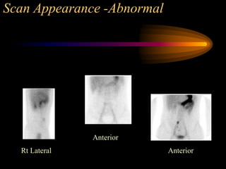 Meckels diverticulum - a nuclear medicine case study | PDF