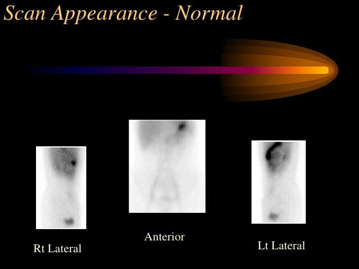 Meckels diverticulum - a nuclear medicine case study