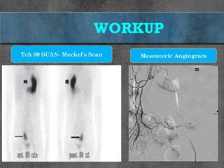 Meckel's Diverticulum - Pediatric Surgery | PPT