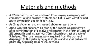 Meckels diverticulum : a rare case of small bowel obstruction in adults ...