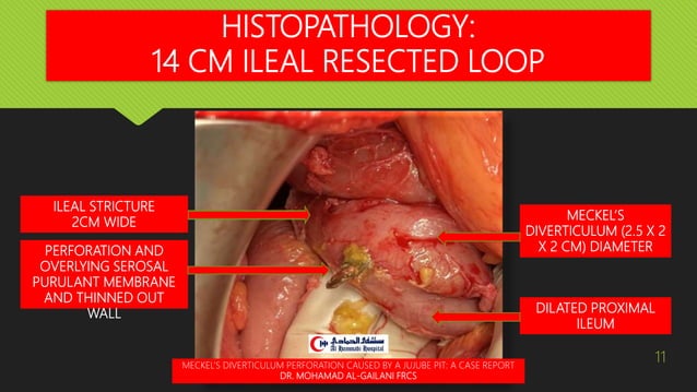 Meckels diverticulum perforation from jujube pit ثقب رتج ميكل الناجم عن ...