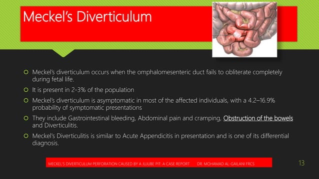 Meckels diverticulum perforation from jujube pit ثقب رتج ميكل الناجم عن ...