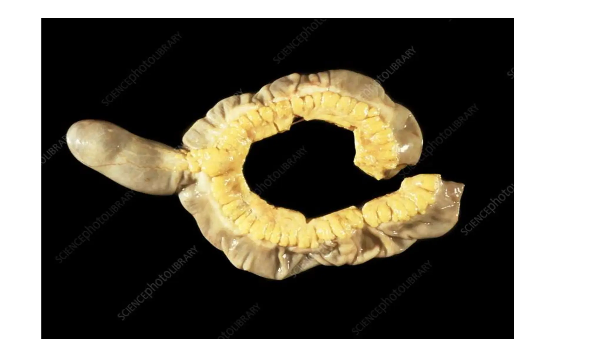 Meckel`s Diveticulum.pptx Meckel's diverticulum is the most common ...