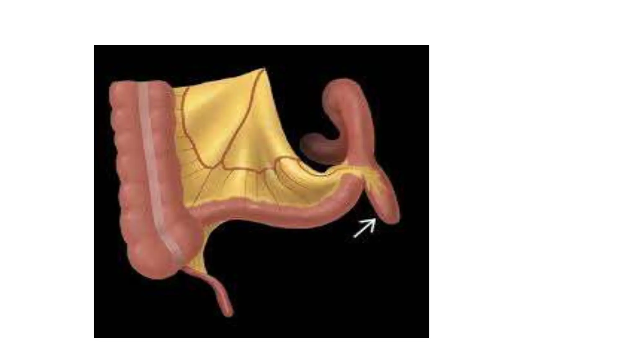 Meckel`s Diveticulum.pptx Meckel's diverticulum is the most common ...