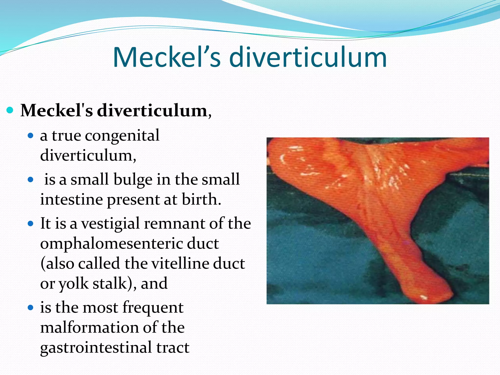 meckels, sigmoid, intussuception.pptx