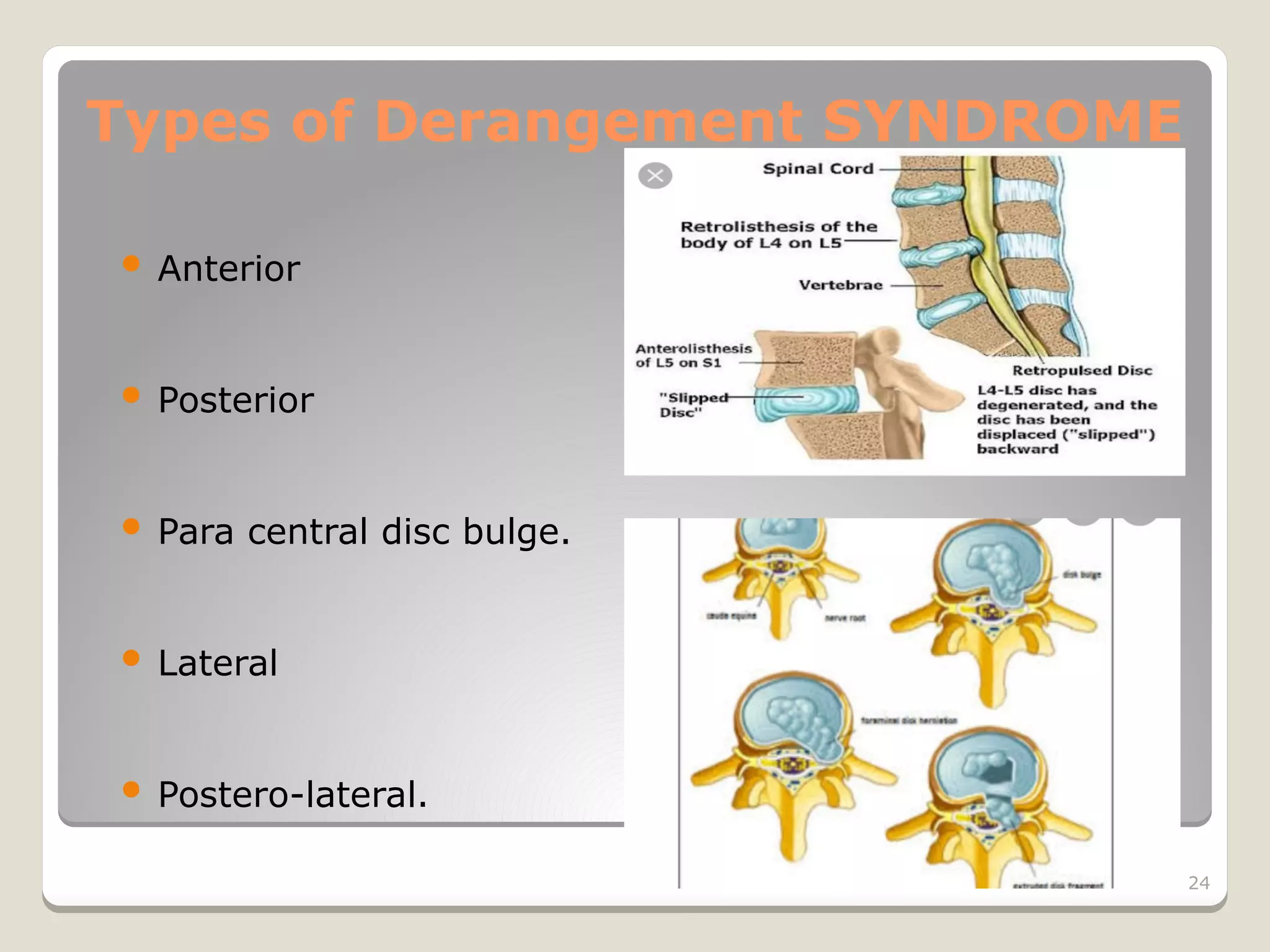 Meckenzie approach | PDF