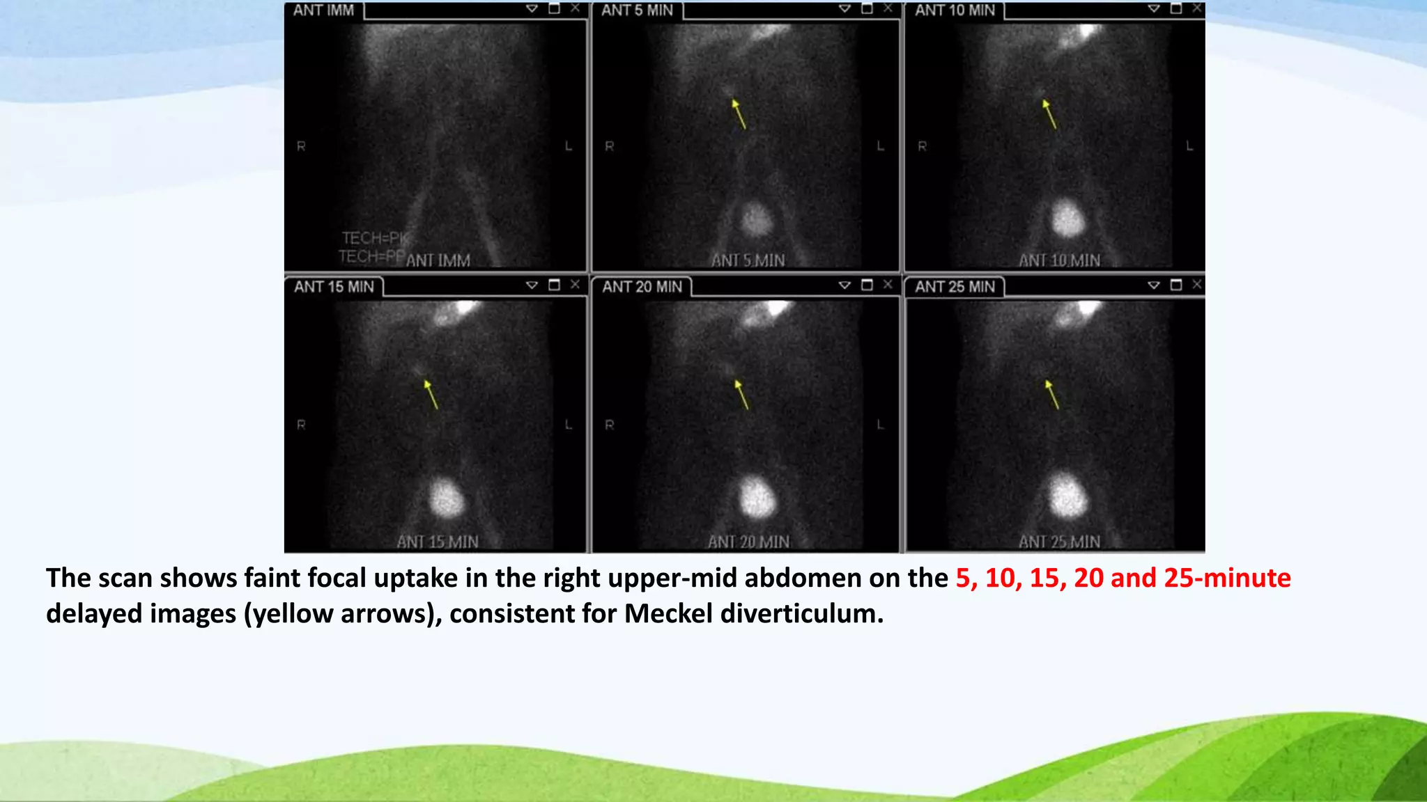 Meckle's scan | PPTX