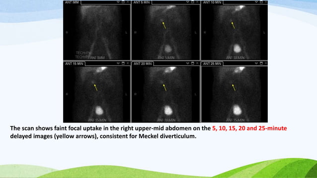 Meckle's scan | PPTX