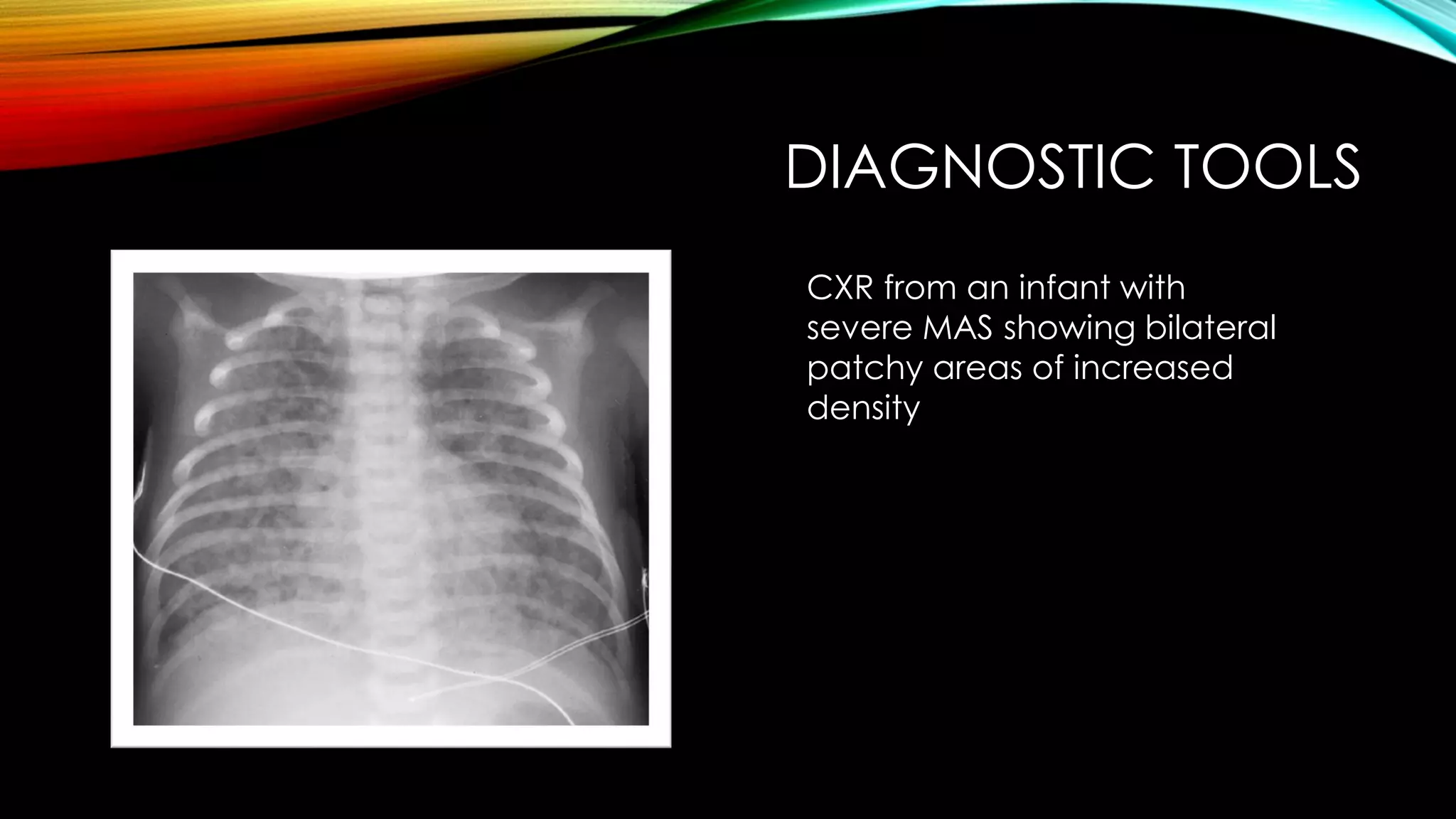 Meconium aspiration syndrome (MAS) | PDF
