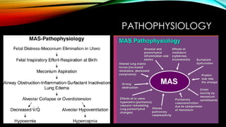 Meconium aspiration syndrome (MAS) | PDF