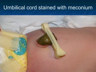 Meconium aspiration syndrome_ | PPT