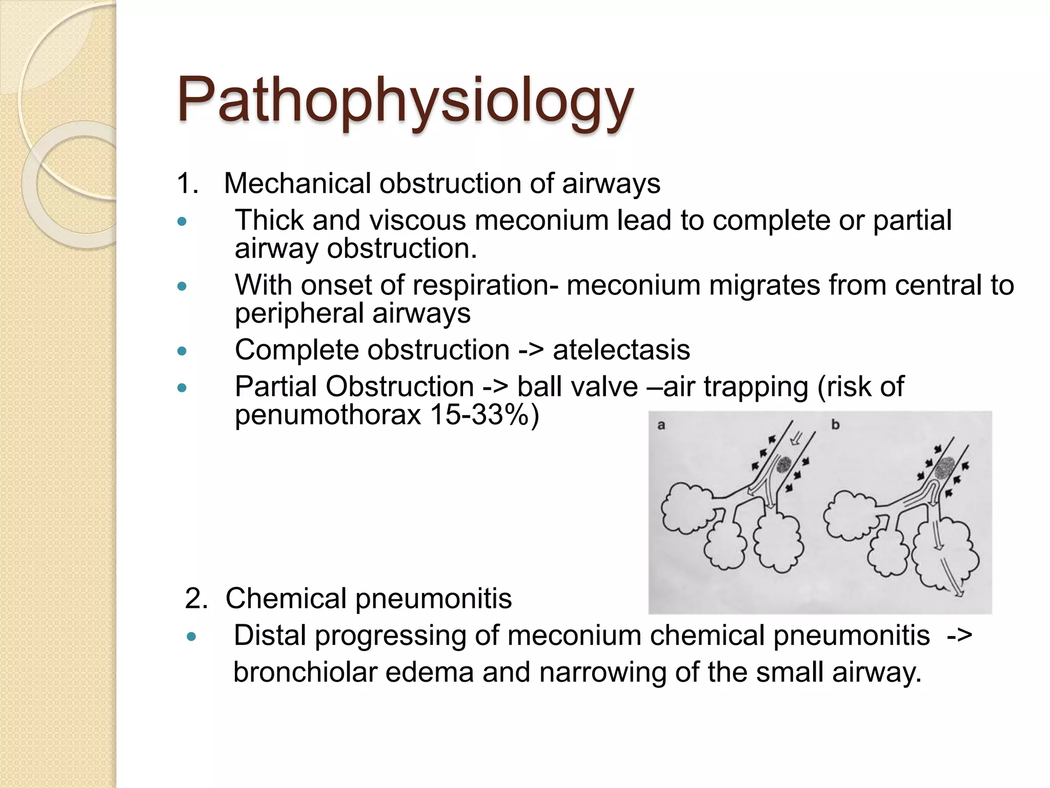 Meconium aspiration syndrome | PPTX