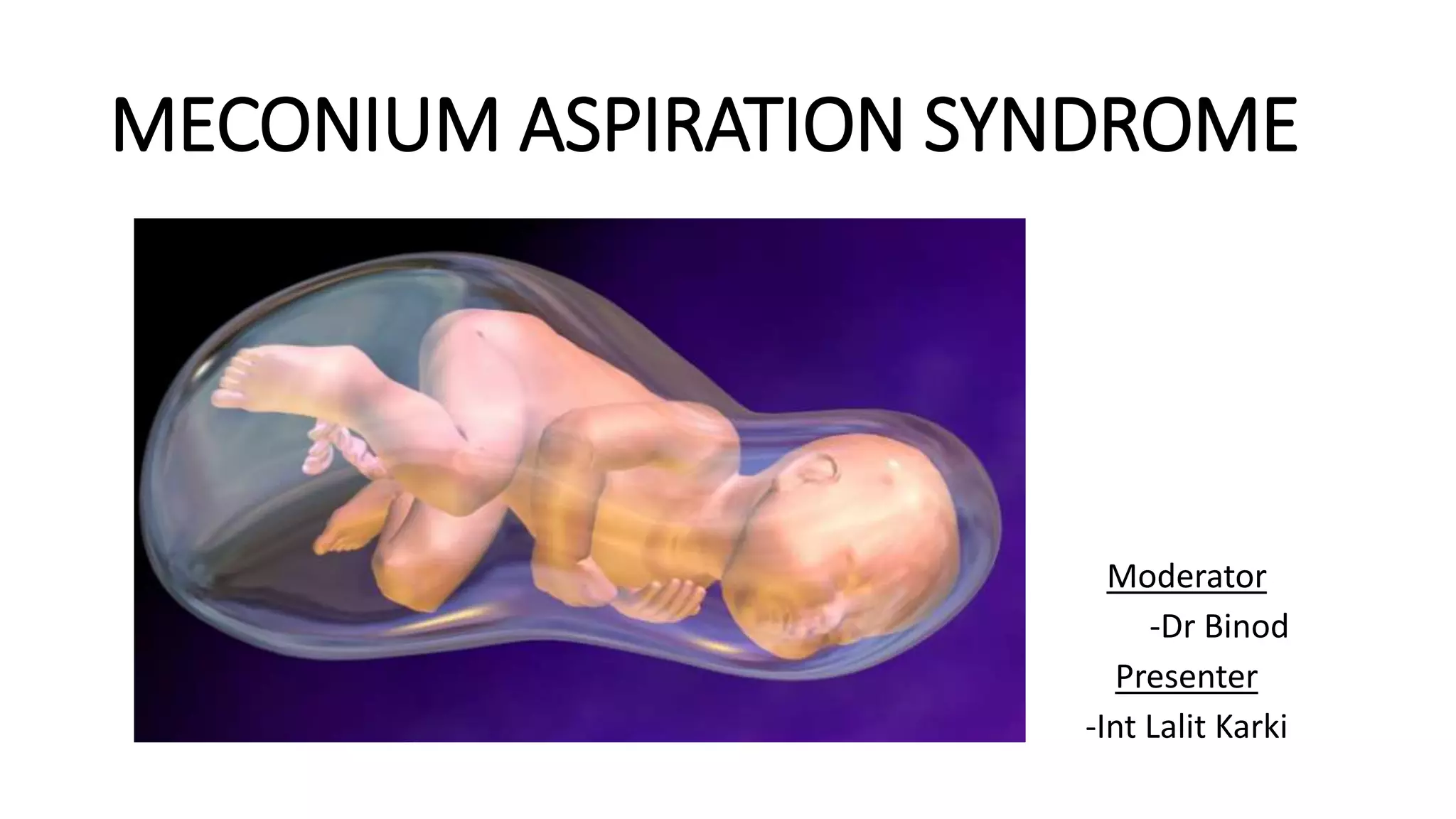 Meconium aspiration syndrome | PPTX