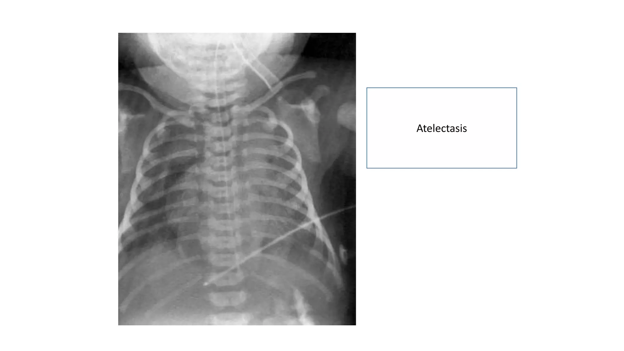Meconium aspiration syndrome | PPTX