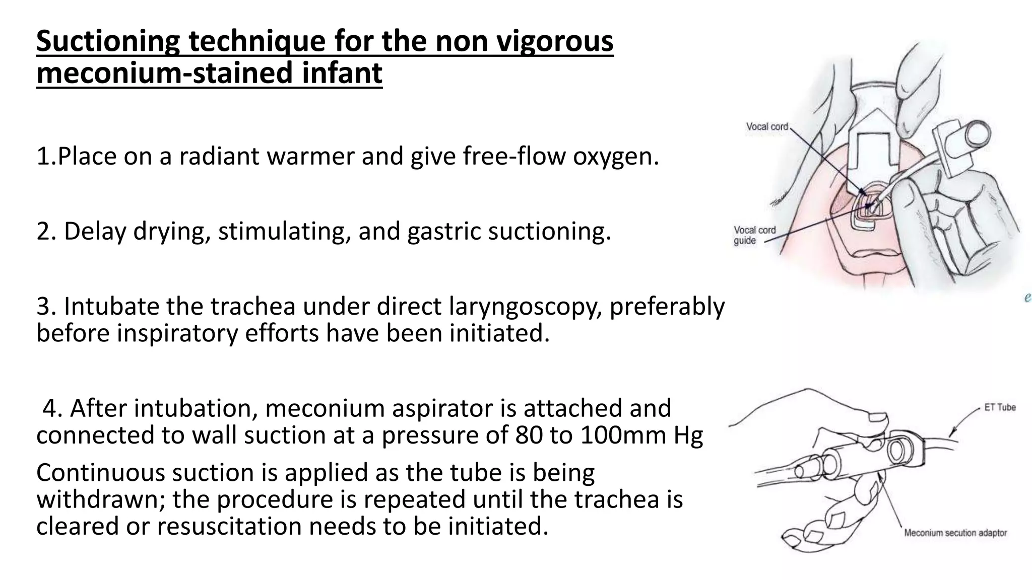 Meconium aspiration syndrome | PPTX