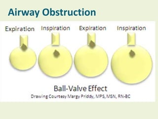 Meconium Aspiration Syndrome | PPT