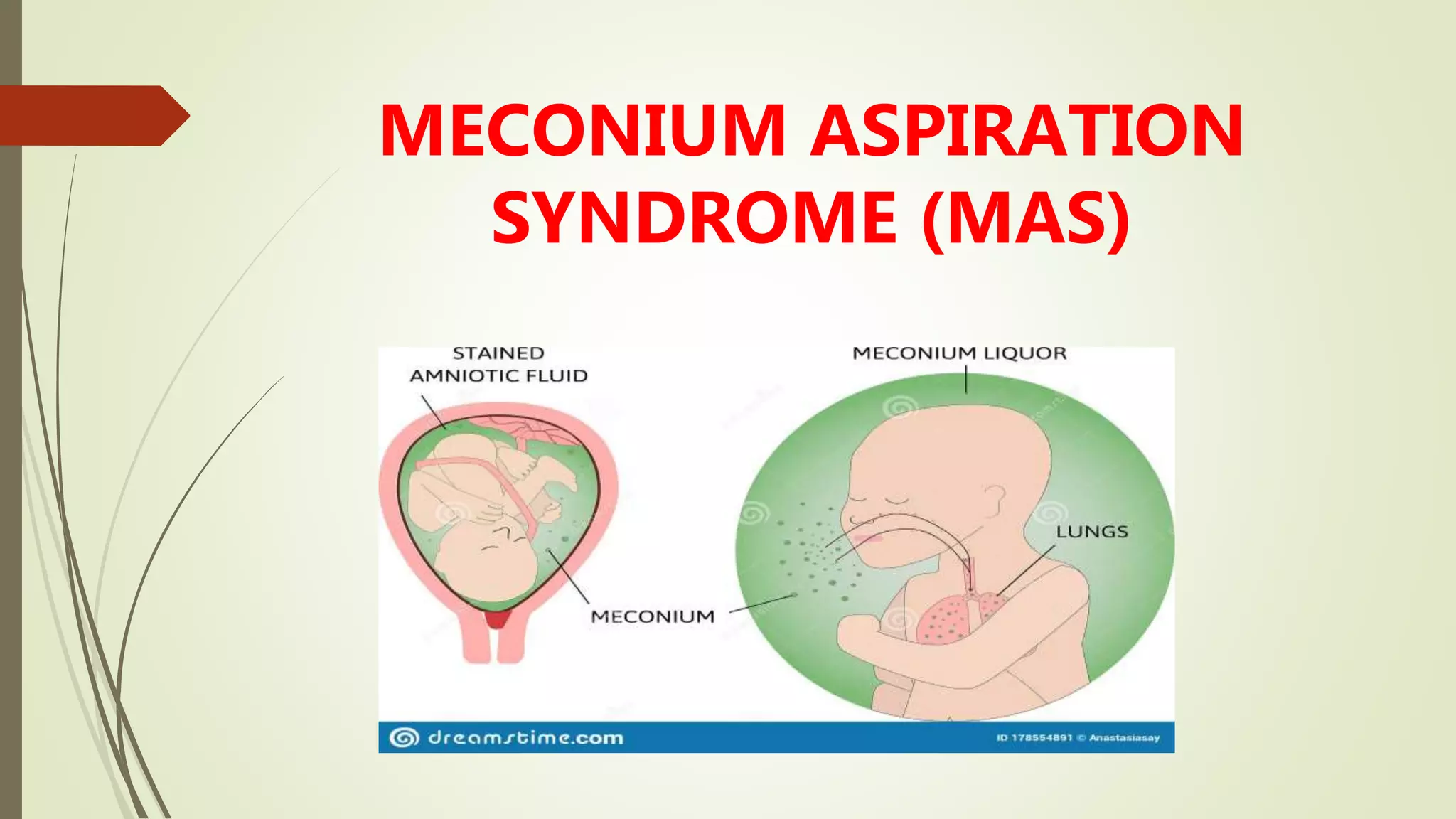 Meconium aspiration syndrome | PPTX